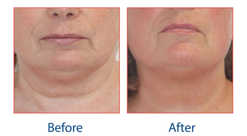Radio Frequency Facial Skin Tightening - Clear Medical Skin Clinic