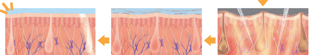 Bio-microneedling Spirella Spicule Peel - Clear Medical Skin Clinic