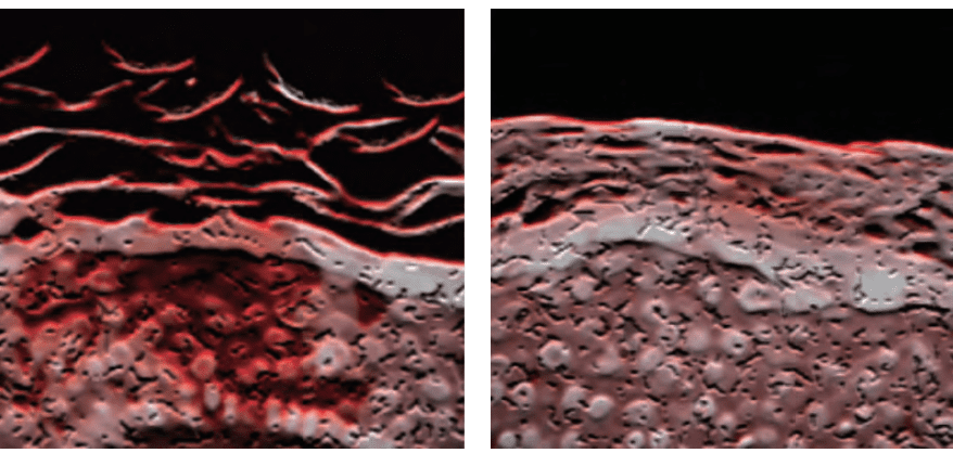 Bio-microneedling Spirella Spicule Peel - Clear Medical Skin Clinic
